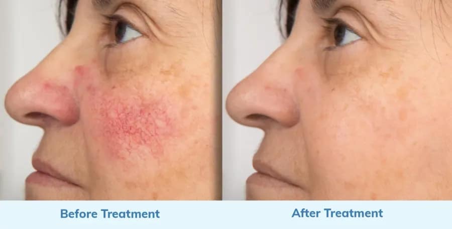 Laser Treatment for Rosacea by Progenaesthetics