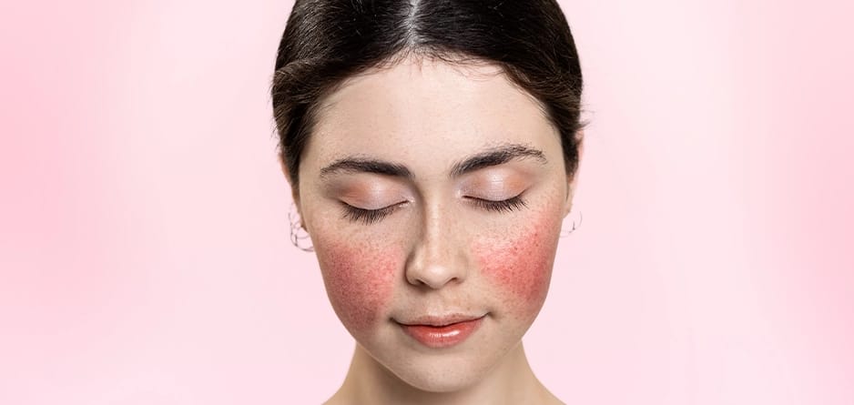 Rosacea Treatment in Bournemouth: A Complete Guide